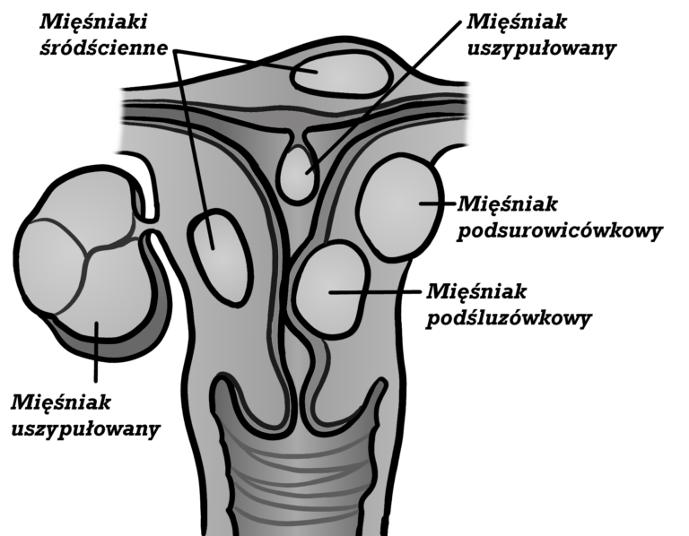 Mięśniaki macicy - przyczyny, diagnostyka i leczenie - Centrum Medyczne ...