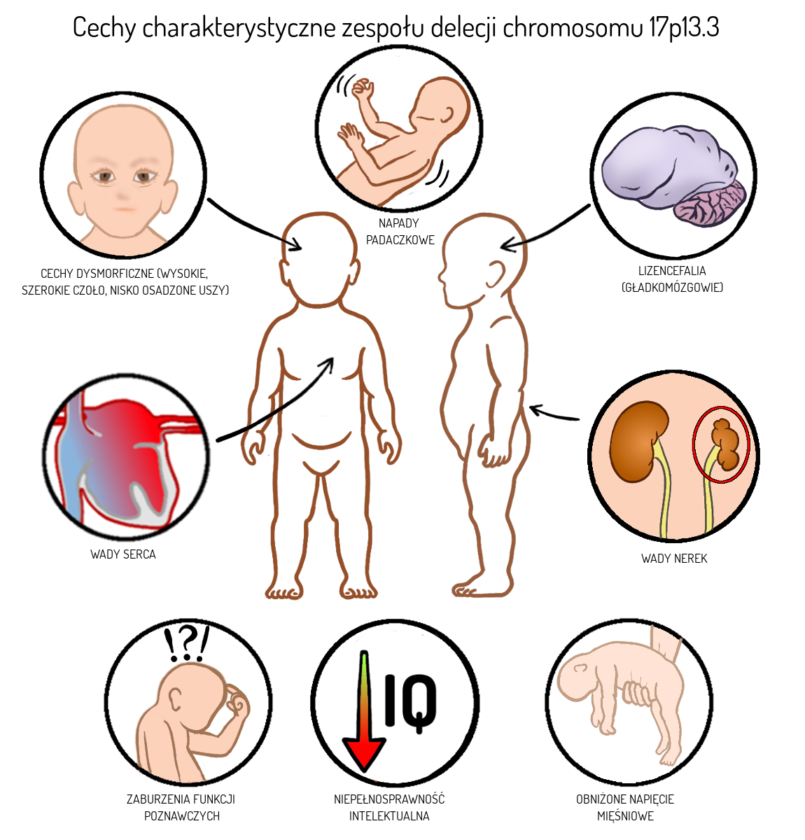 Zespół delecji chromosomu 17p13.3 - Przyczyny - Objaw - Diagnostyka ...